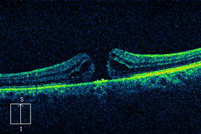 macular hole